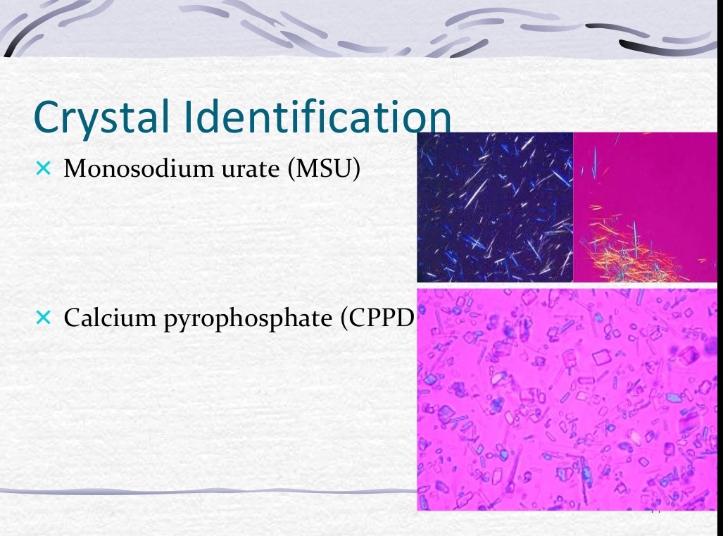 What Is Synovial Fluid Analysis At Russel Bump Blog What Is Synovial Fluid Analysis At Russel Bump Blog