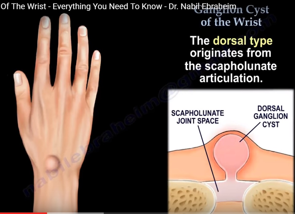Can A Ganglion Cyst Cause Wrist Pain At Charles Banks Blog
