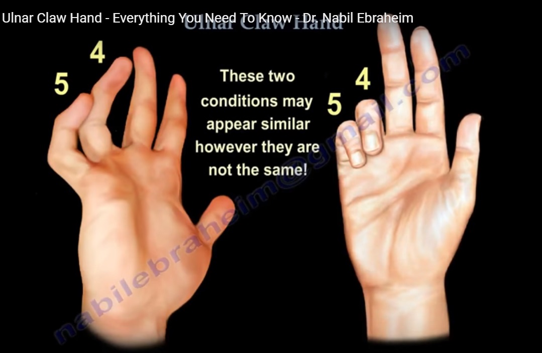 Ulnar Claw Hand OrthopaedicPrinciples Ulnar Claw Hand OrthopaedicPrinciples