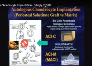 Autologous Chondrocyte Implantation — OrthopaedicPrinciples.com
