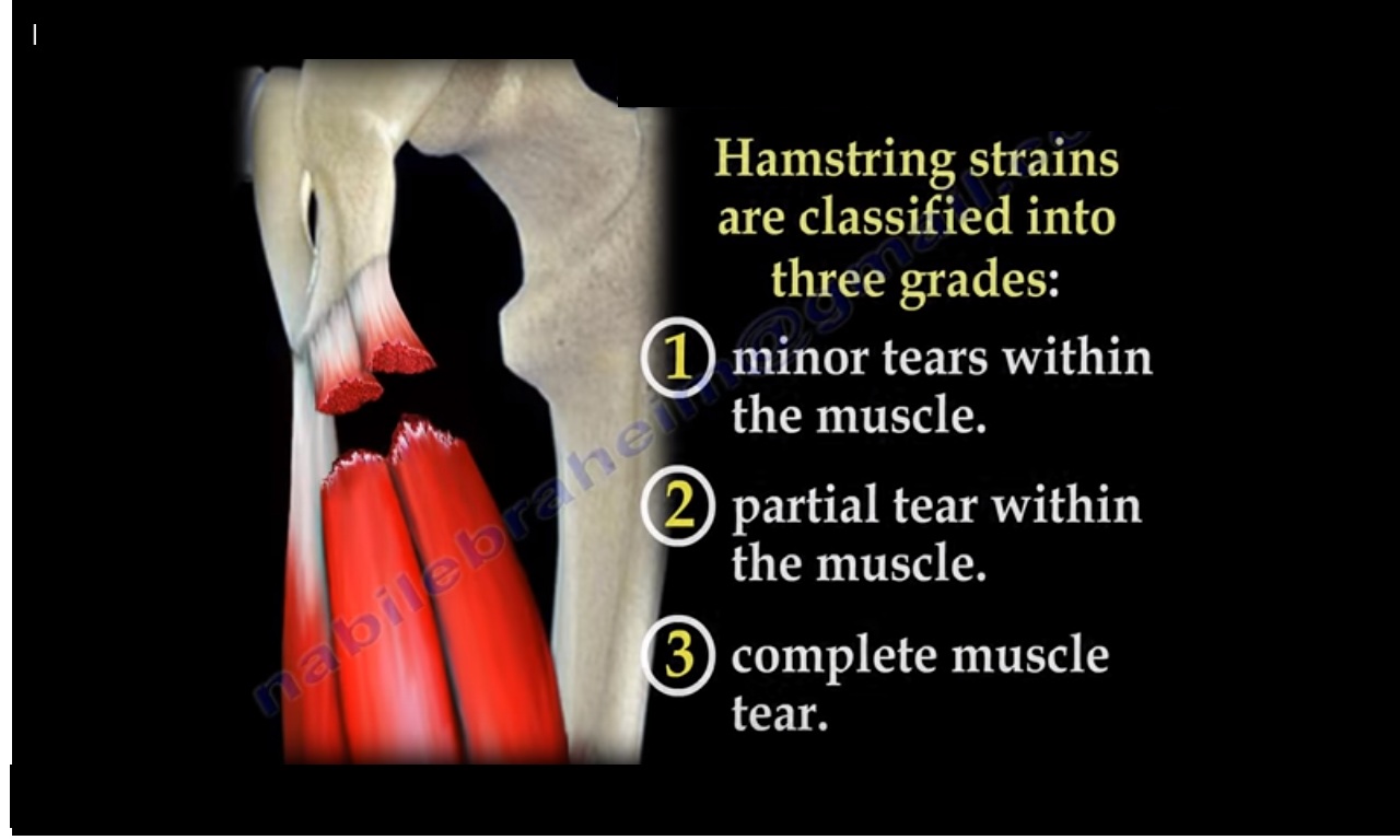 Hamstring Injuries OrthopaedicPrinciples Hamstring Injuries OrthopaedicPrinciples