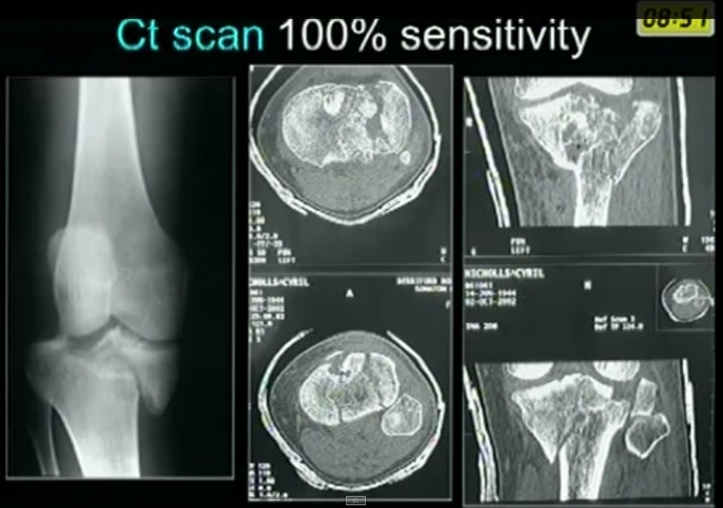 Proximal Tibia Fractures — OrthopaedicPrinciples.com
