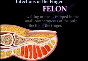 Infections of the Finger — OrthopaedicPrinciples.com