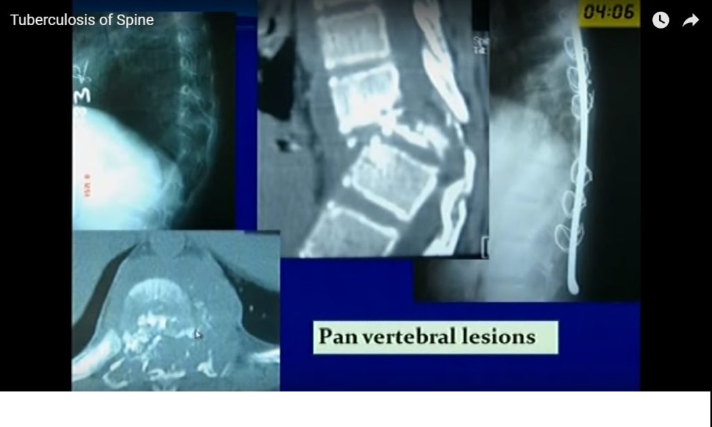 Tuberculosis of Spine — OrthopaedicPrinciples.com