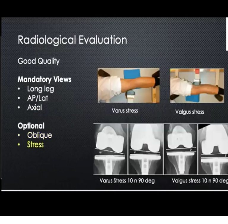 Radiographic Criteria for Optimum TKR — OrthopaedicPrinciples.com