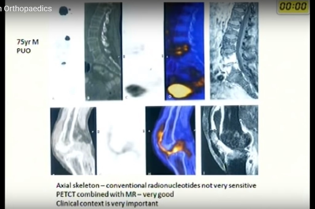 Positron Emission Tomography(PET Scan) in Orthopaedics ...