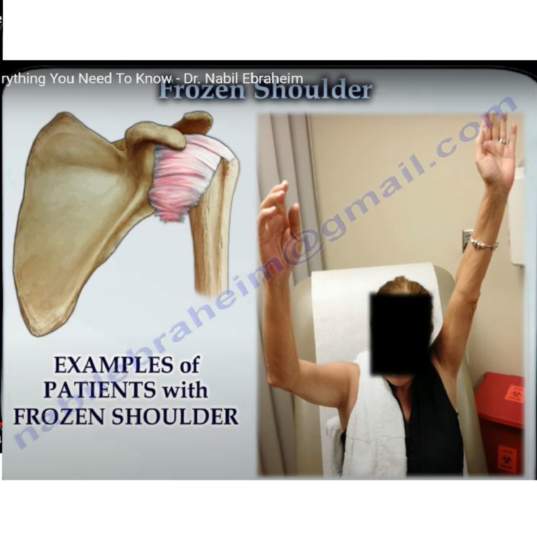 Frozen Shoulder Basics — OrthopaedicPrinciples.com