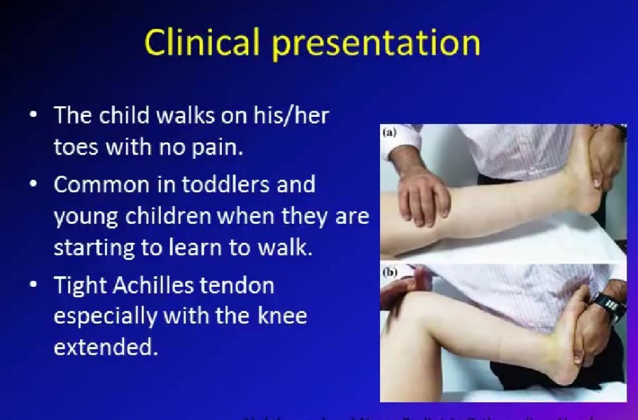 Idiopathic #Toe Walking — OrthopaedicPrinciples.com