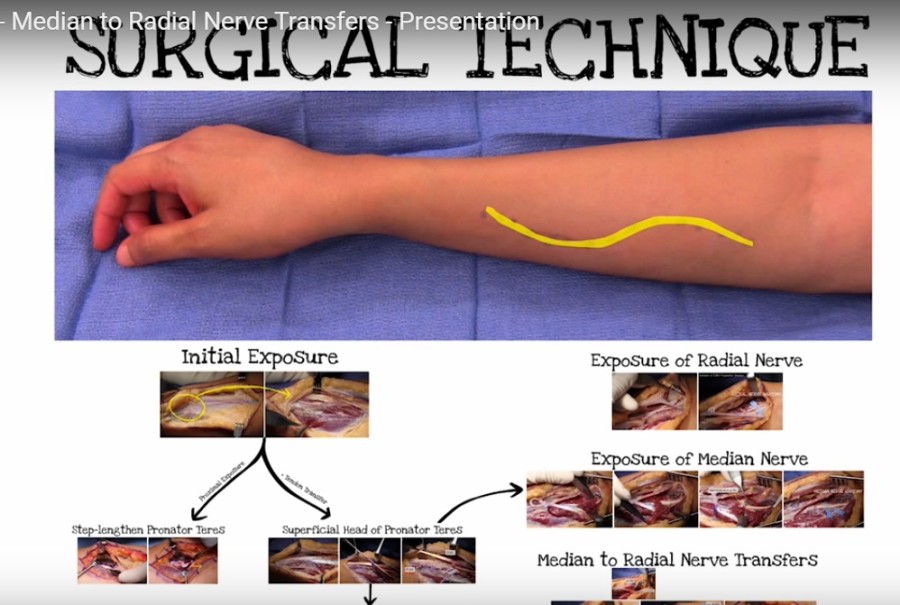 Median to Radial Nerve Transfers — OrthopaedicPrinciples.com