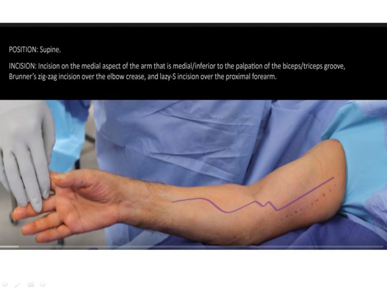 Brachialis to Anterior Interosseous Nerve Transfer with Extended ...