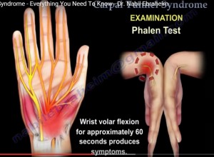 Examination Of The Hand, Carpal Tunnel Syndrome — OrthopaedicPrinciples.com