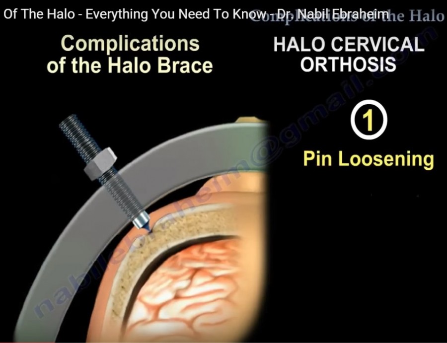 Complications of the #Halo — OrthopaedicPrinciples.com