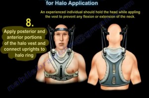 Halo Placement: #Anatomical Considerations — OrthopaedicPrinciples.com