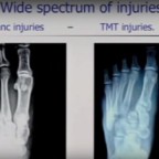 Lisfranc Joint Injury — OrthopaedicPrinciples.com