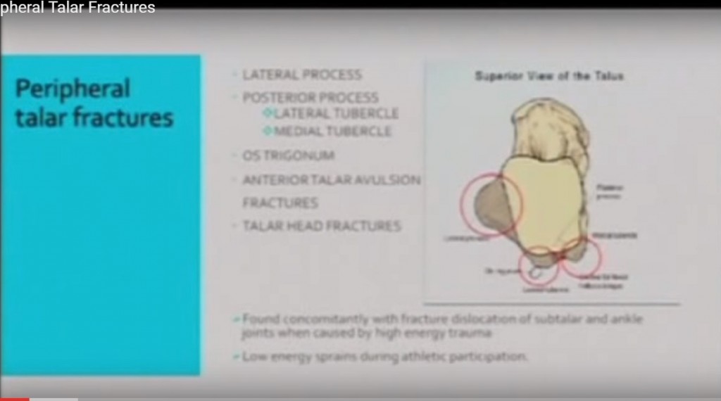 Peripheral Talar #Fractures — OrthopaedicPrinciples.com