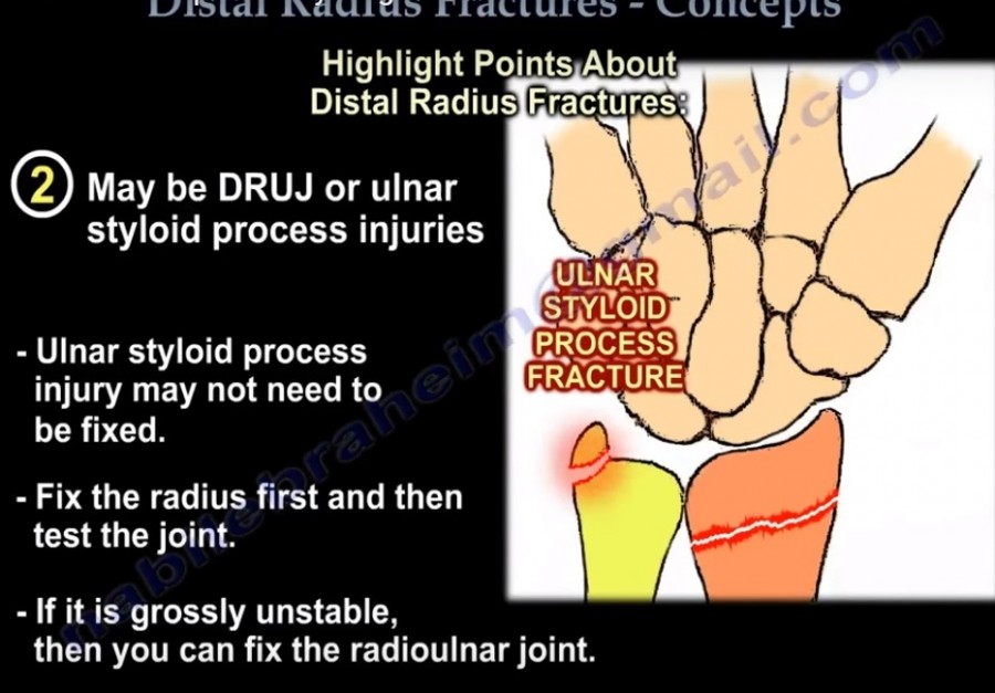 Distal Radius #Fracture: Concepts — OrthopaedicPrinciples.com