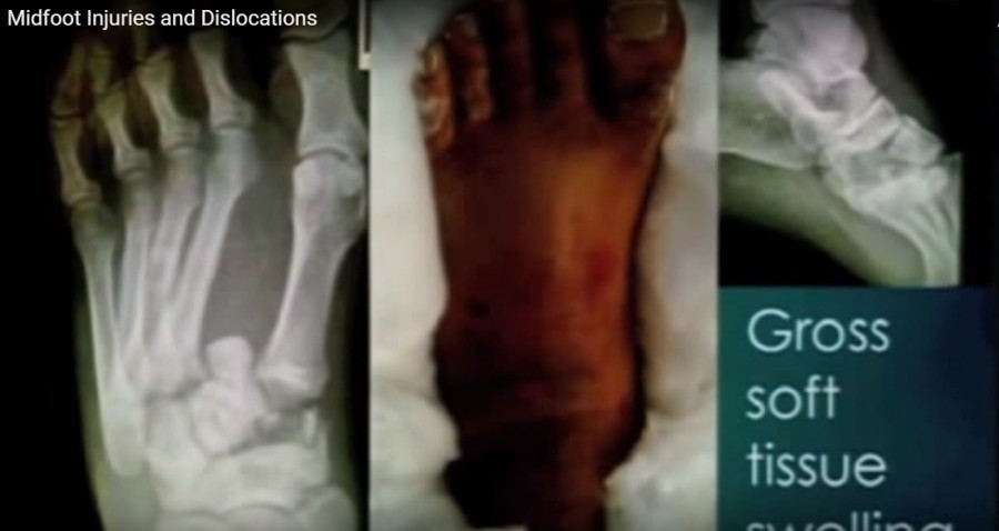 Midfoot Injuries and #Dislocations — OrthopaedicPrinciples.com