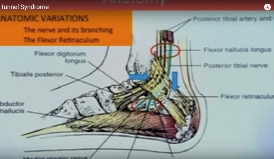 Tarsal Tunnel #Syndrome — OrthopaedicPrinciples.com