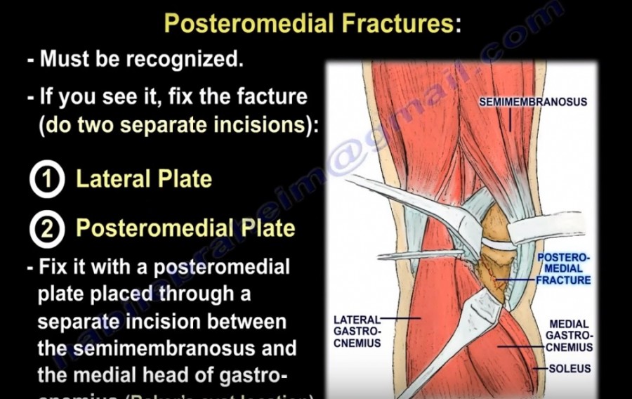 Tibial Plateau #Fractures — OrthopaedicPrinciples.com