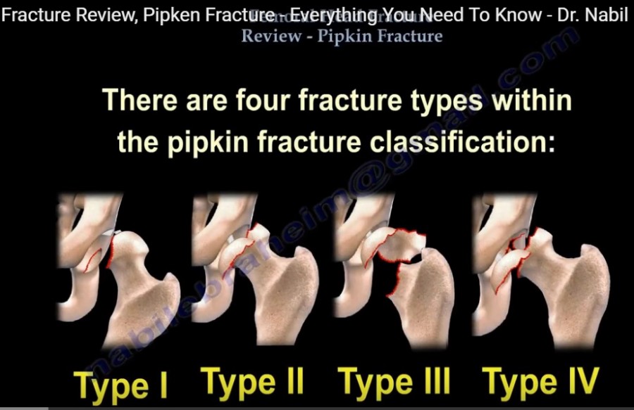 Pipkin fracture of Femoral Head — OrthopaedicPrinciples.com