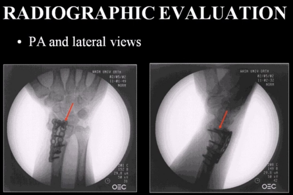 Distal Radius ACUMED DISTAL RADIUS PLATE PDF