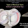 McMurray’s Test for Meniscal Tear — OrthopaedicPrinciples.com