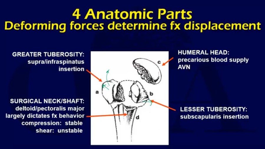 Proximal Humerus Fractures: Diagnosis and Decision-Making ...