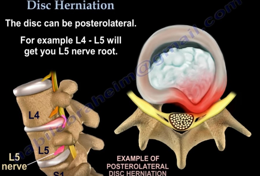 Spine Concepts: Disc Herniation — OrthopaedicPrinciples.com