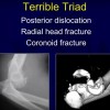 Terrible Triad of Elbow — OrthopaedicPrinciples.com