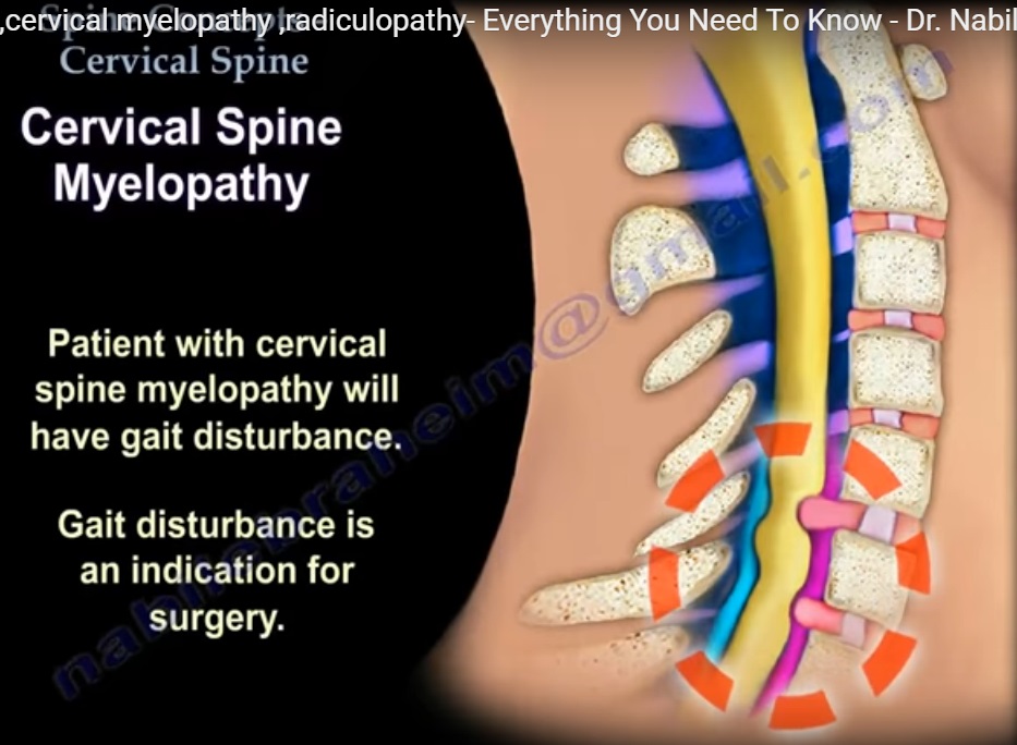 Cervical Myelopathy Radiculopathy OrthopaedicPrinciples Cervical Myelopathy Radiculopathy OrthopaedicPrinciples