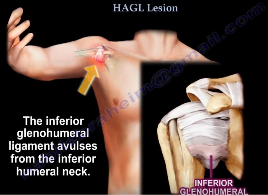 Humeral Avulsion Of Glenohumeral Ligament HAGL OrthopaedicPrinciples Humeral Avulsion Of Glenohumeral Ligament HAGL OrthopaedicPrinciples