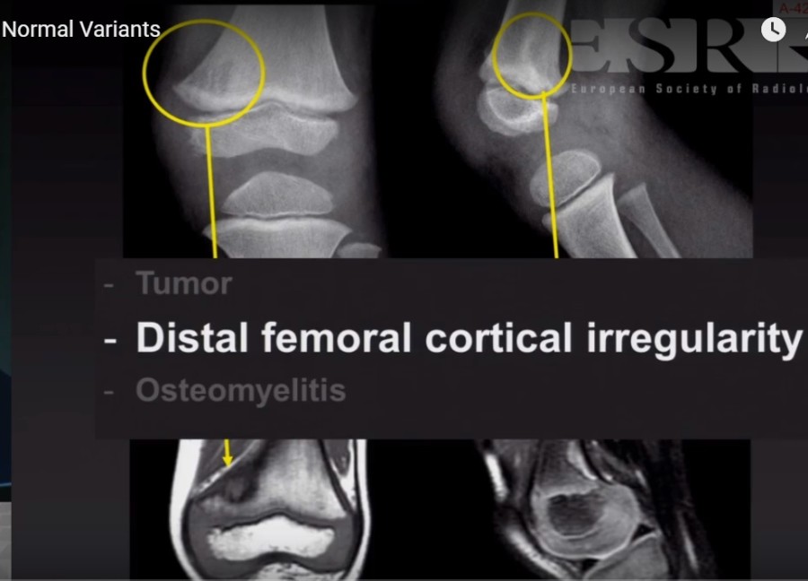Normal variants of Paediatric Orthopaedic disorders ... Normal variants of Paediatric Orthopaedic disorders ...
