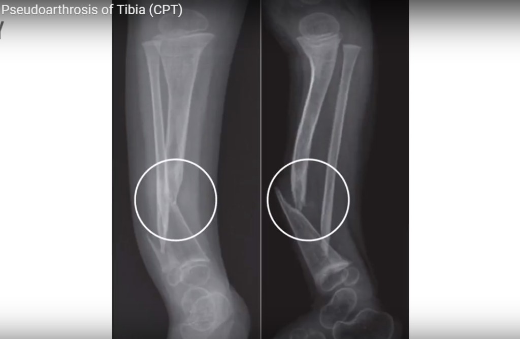 Congenital Pseudoarthrosis of Tibia — OrthopaedicPrinciples.com
