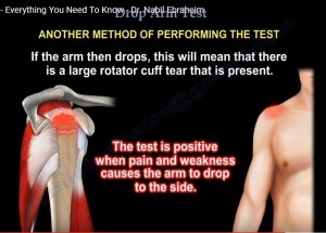 Drop Arm sign in Rotator Cuff Disease — OrthopaedicPrinciples.com
