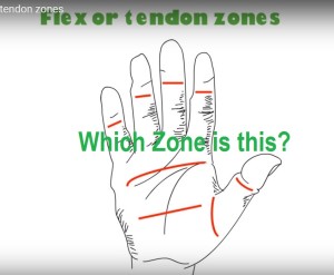Flexor Tendon Zones of the Hand — OrthopaedicPrinciples.com