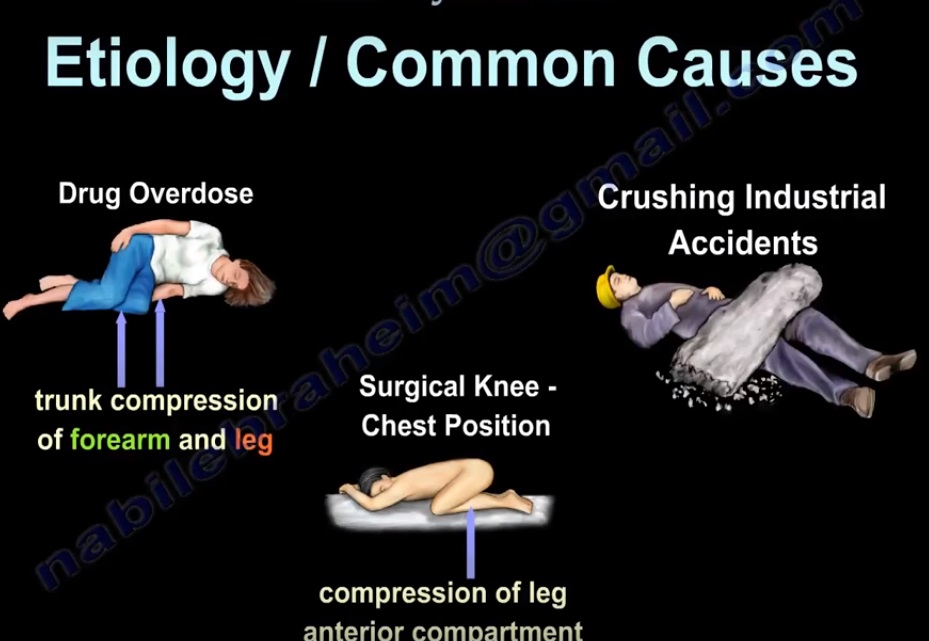 Crush Syndrome OrthopaedicPrinciples