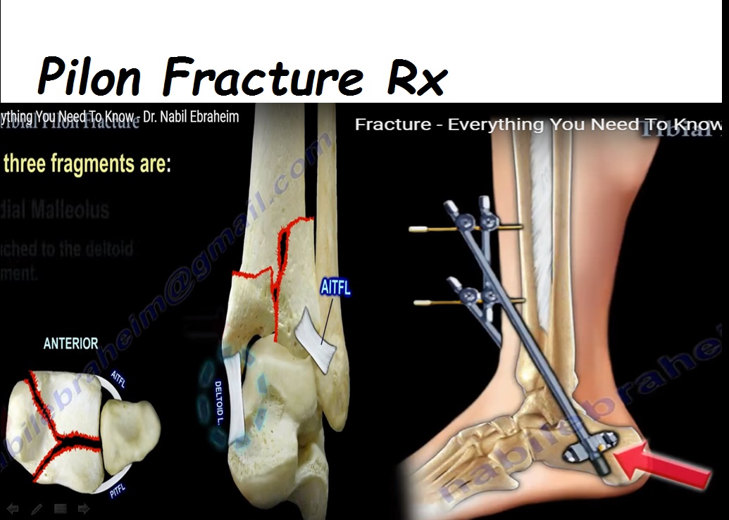 Tibial Pilon Fracture Management OrthopaedicPrinciples Tibial Pilon Fracture Management OrthopaedicPrinciples