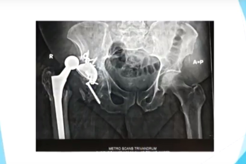 Superior capsule reconstruction for irreparable rotator cuff tear ...