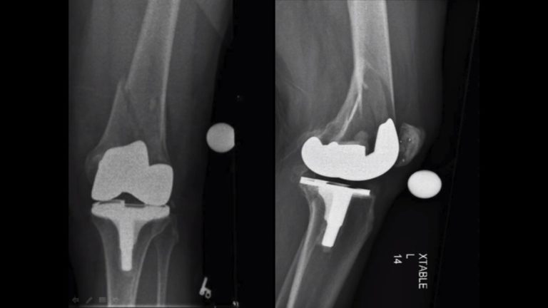 Lateral Distal Femur Plate for Periprosthetic Fracture ...