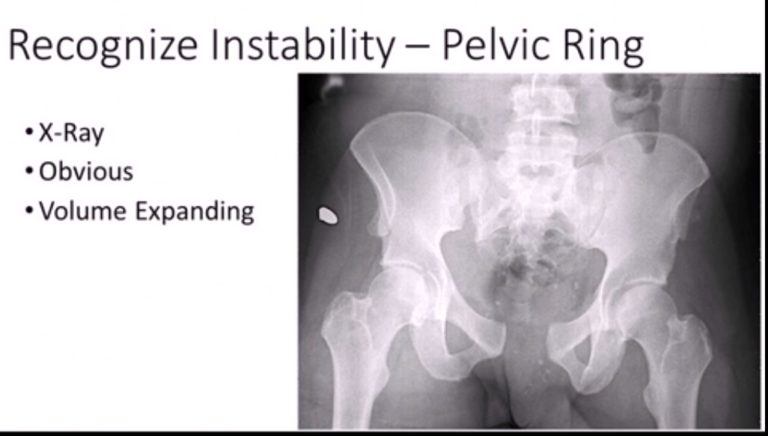 Pelvic Injuries In Children — OrthopaedicPrinciples.com
