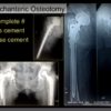 Bone Cement — OrthopaedicPrinciples.com