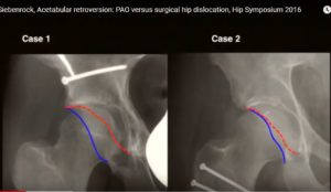 Acetabular Retroversion: PAO versus Surgical hip dislocation ...