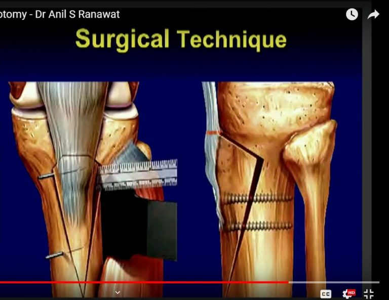 Tibial Slope Changing and Tubercle Osteotomy — OrthopaedicPrinciples.com