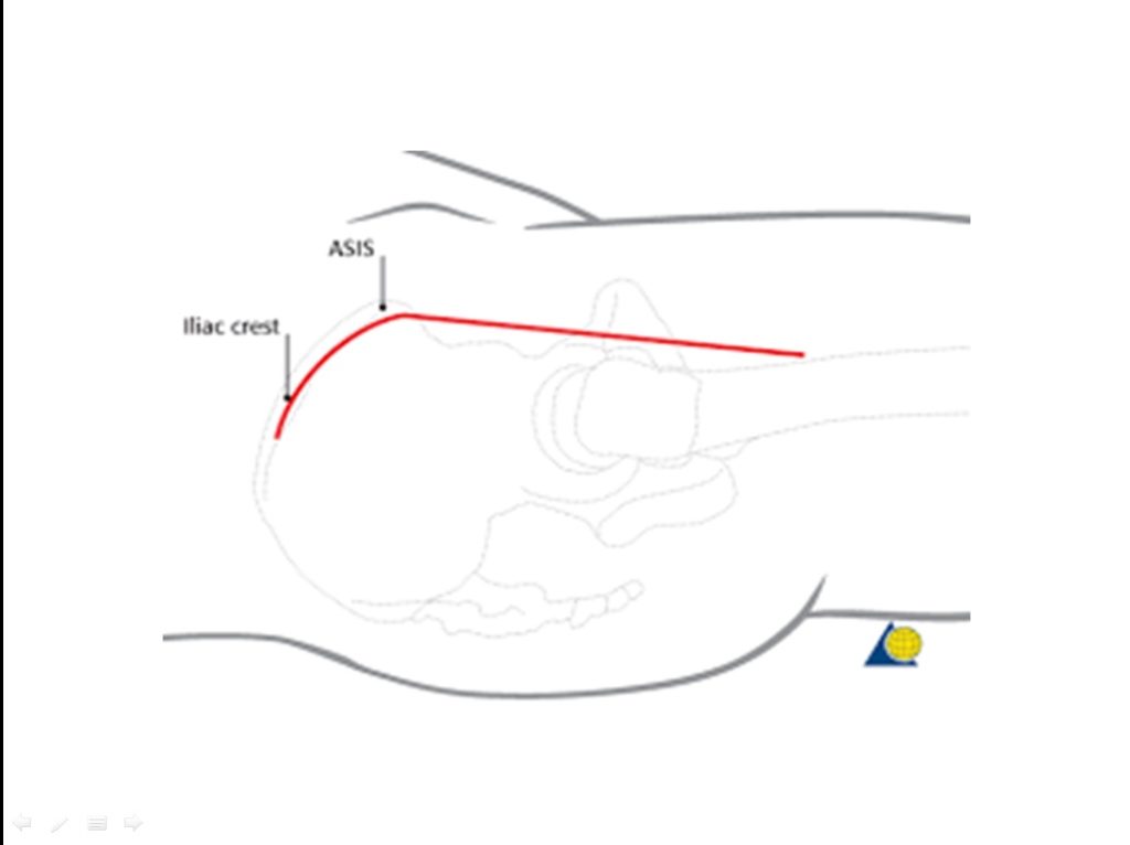 Iliofemoral approach for Acetabular fractures — OrthopaedicPrinciples.com