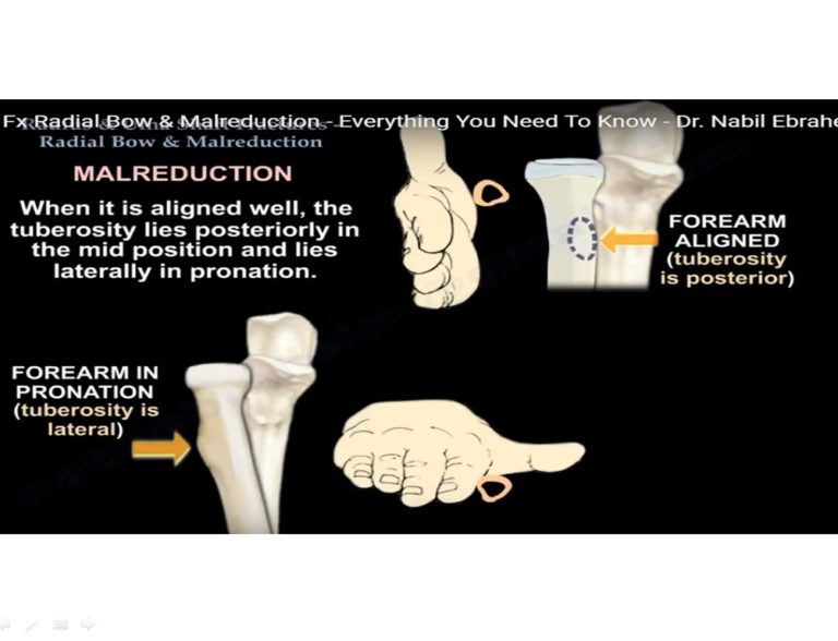Radial bow and Alignment in Forearm fractures — OrthopaedicPrinciples.com