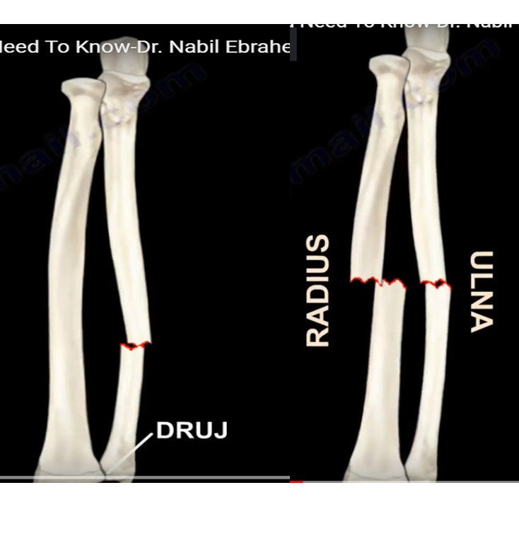 Radius And Ulna Shaft Fractures OrthopaedicPrinciples