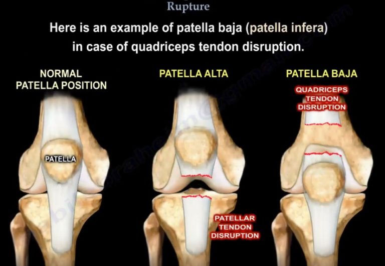 Quadriceps Tendon Rupture OrthopaedicPrinciples