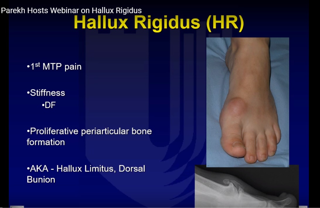 Hallux Rigidus Treatment Modalities OrthopaedicPrinciples