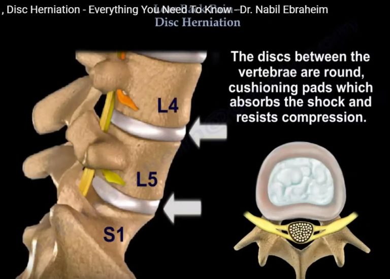 Low Back Ache and Lumbar Disc Herniation — OrthopaedicPrinciples.com