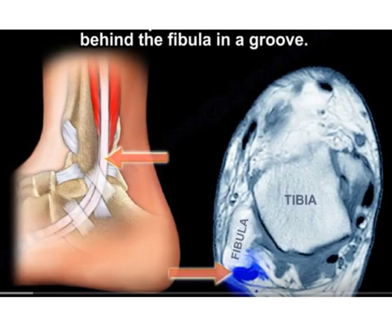 Peroneal Tendon Subluxation and Dislocation — OrthopaedicPrinciples.com